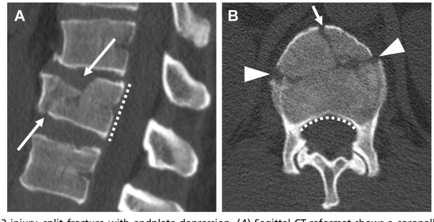 LESION ESPINAL TRAUMATICA - Mind Map
