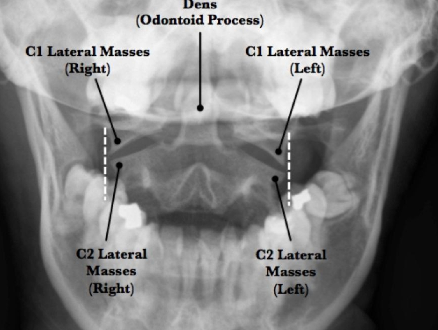 LESION ESPINAL TRAUMATICA - Mind Map