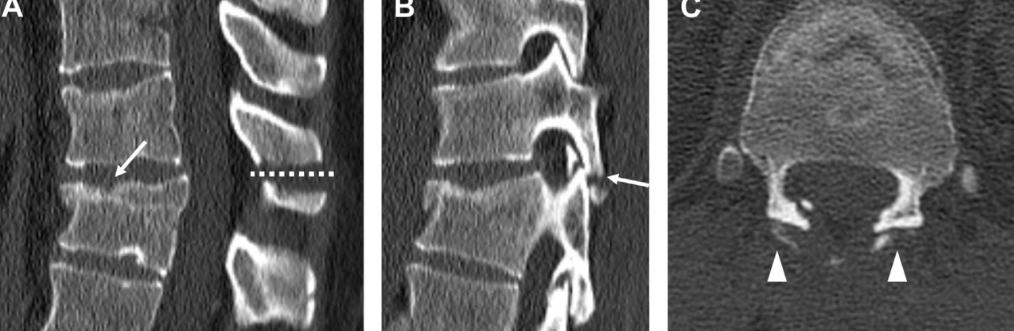 LESION ESPINAL TRAUMATICA - Mind Map