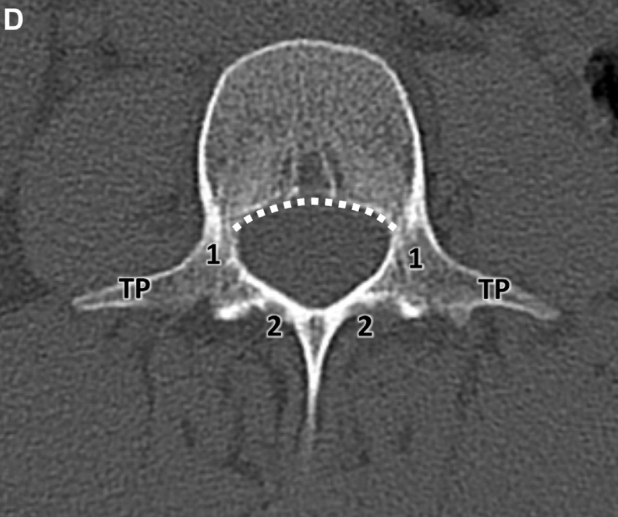 LESION ESPINAL TRAUMATICA - Mind Map