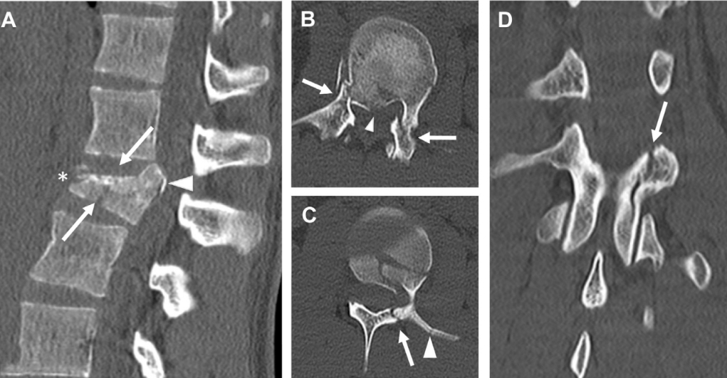 LESION ESPINAL TRAUMATICA - Mind Map