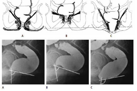 Incontinencia fecal - Mind Map