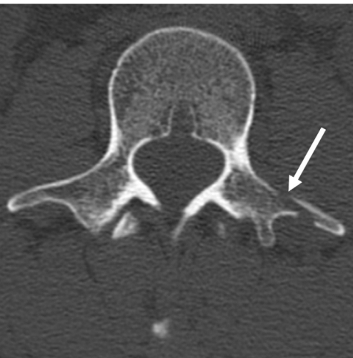 LESION ESPINAL TRAUMATICA - Mind Map