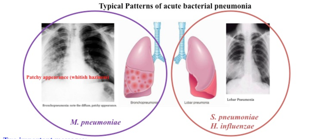 Bacterial Pneumonia - Mind Map