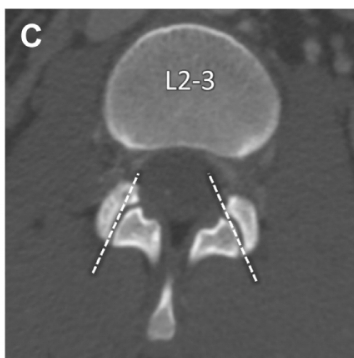 LESION ESPINAL TRAUMATICA - Mind Map