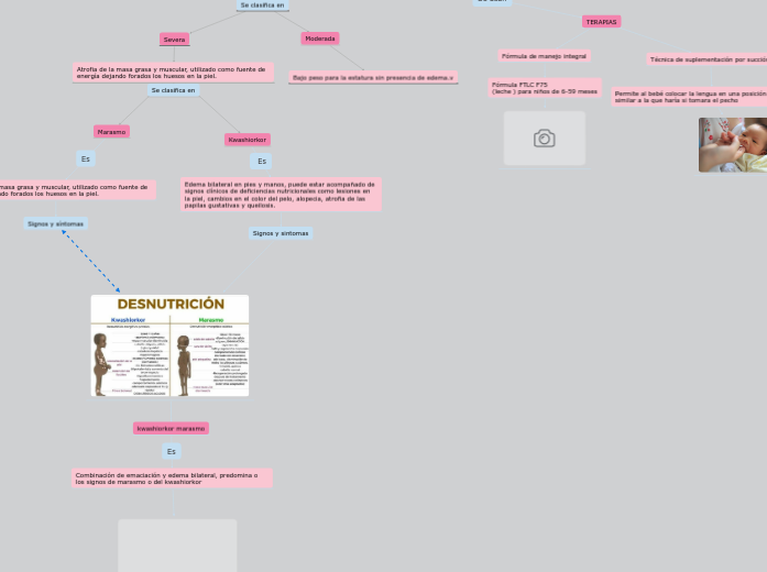 MALNUTRICIÓN - Mind Map